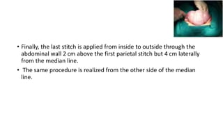 3 New removable uterine compression sutures | PPTX