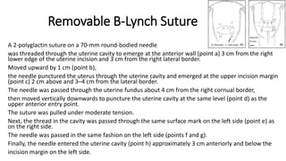 3 New removable uterine compression sutures | PPTX