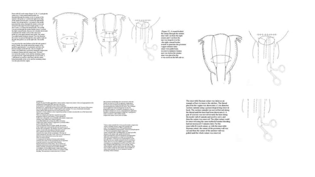3 New removable uterine compression sutures | PPTX | Pregnancy ...