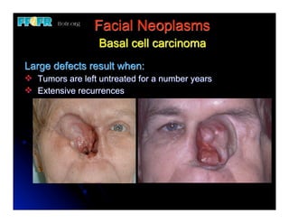 (New) restoration of facial defects basic priniciples | PDF