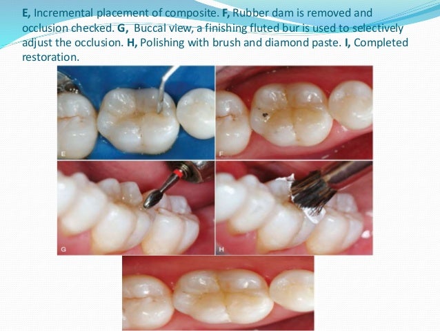 posterior direct composite restoration
