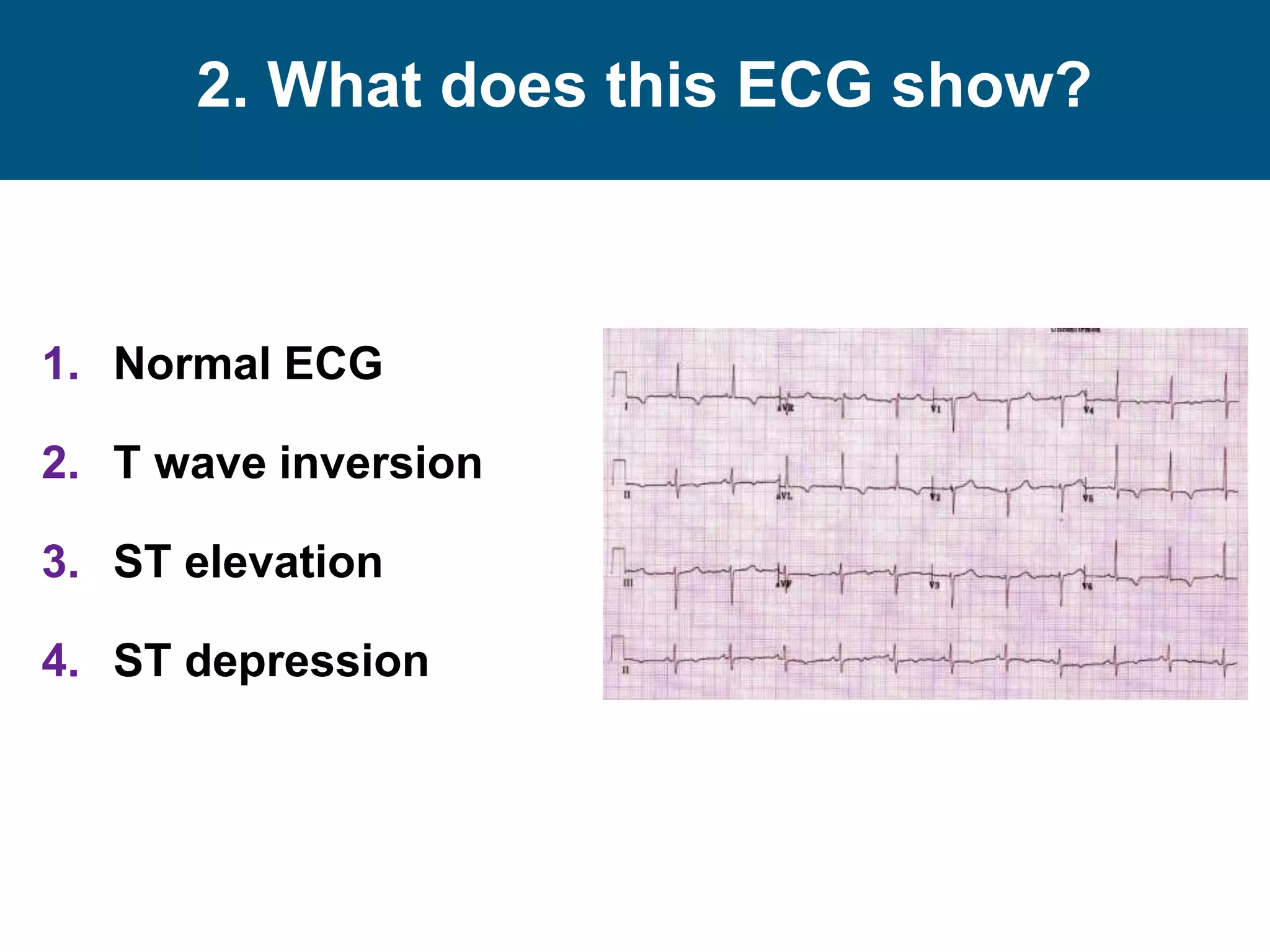 ECG interpretation: NSTEMI | PPTX