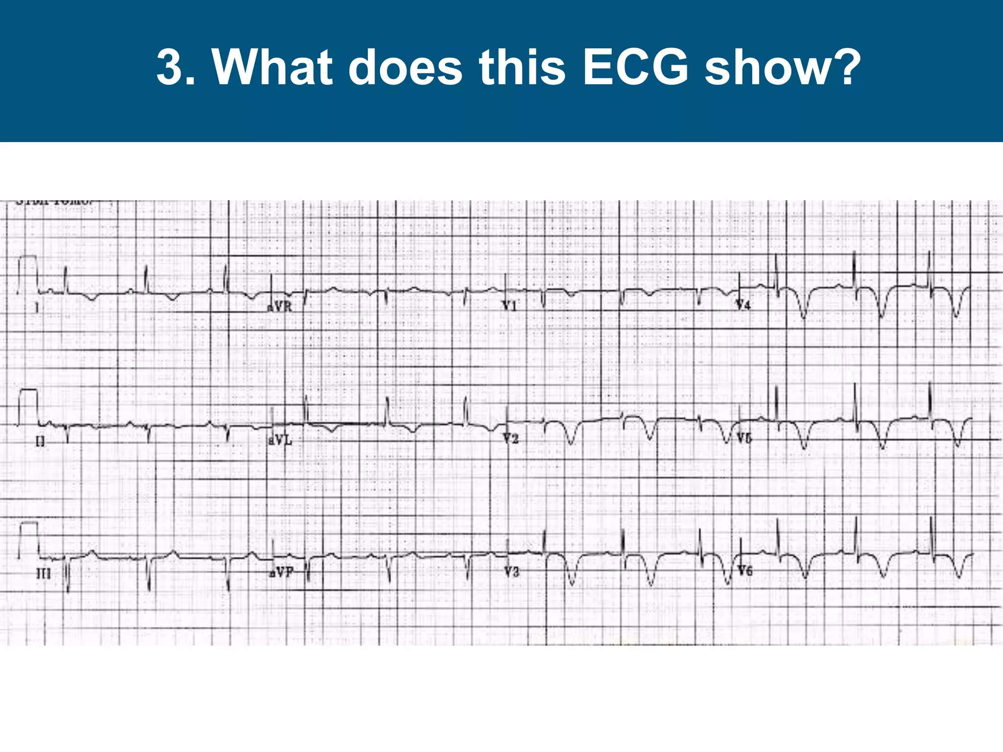 ECG interpretation: NSTEMI | PPTX