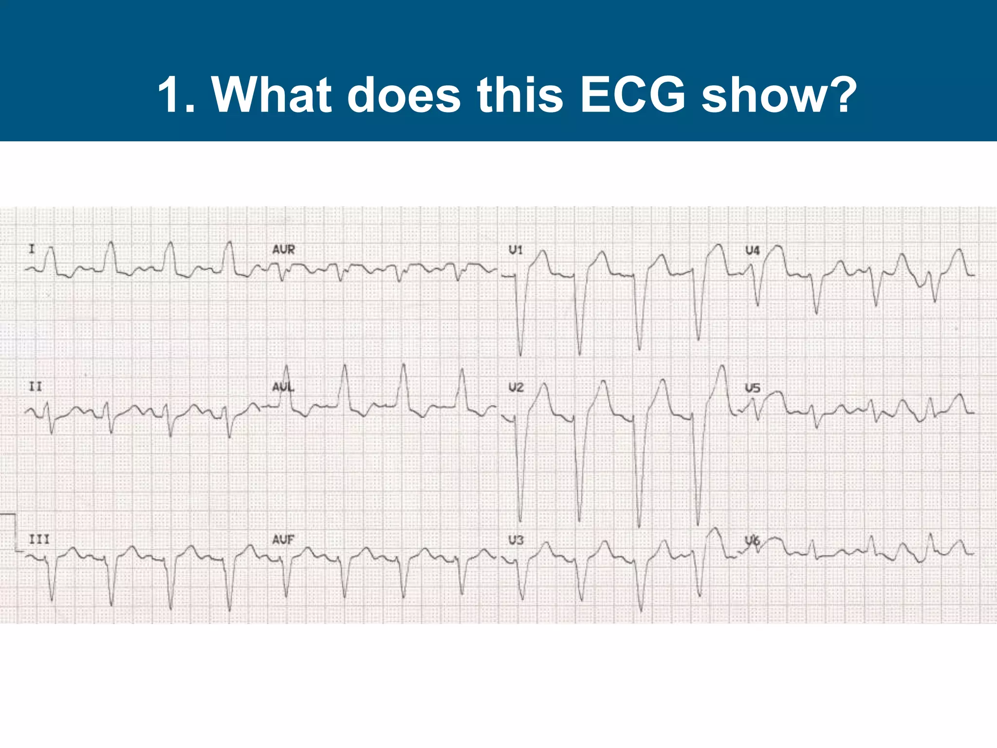 ECG interpretation: NSTEMI | PPTX