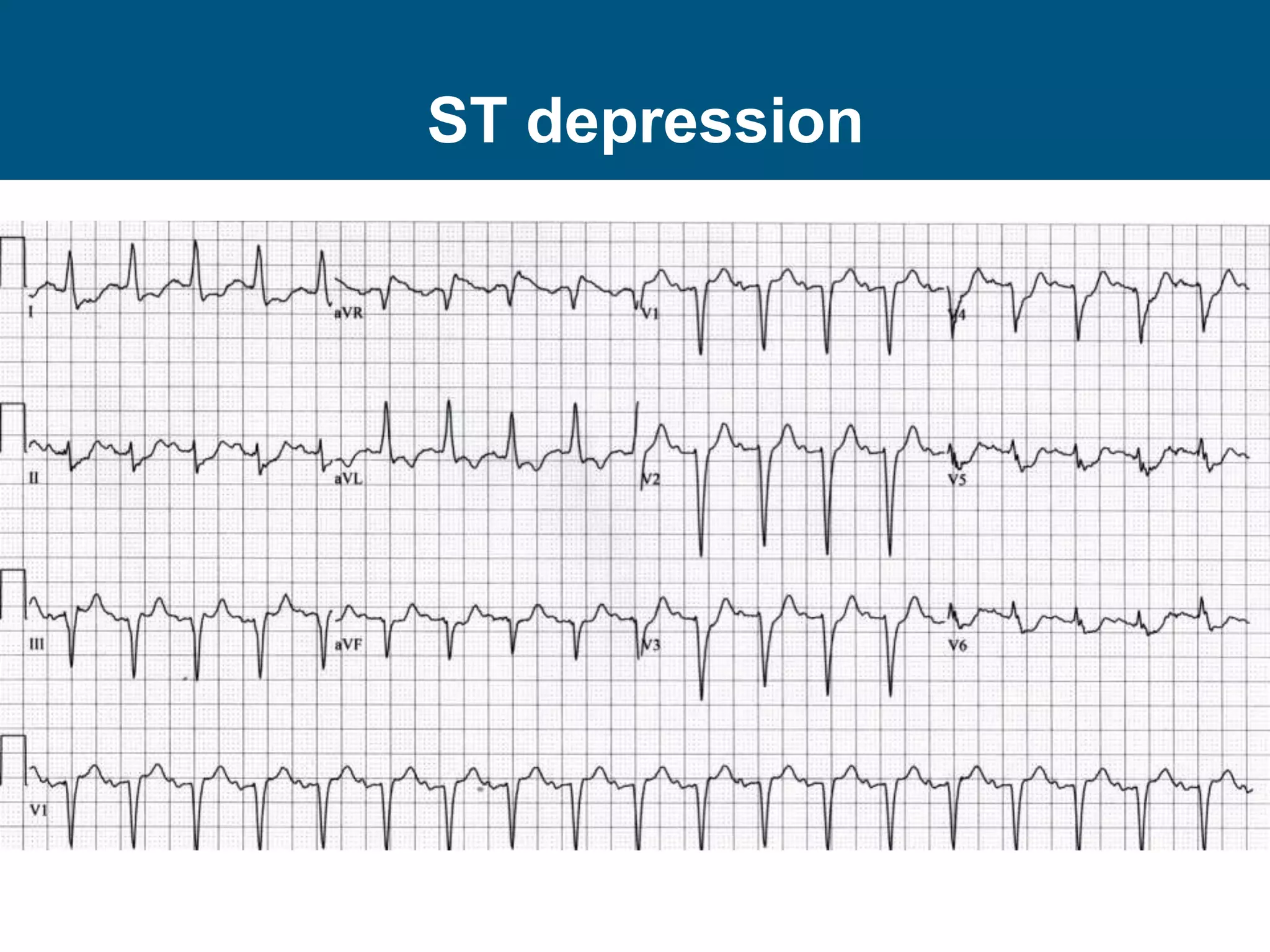 ECG interpretation: NSTEMI | PPTX