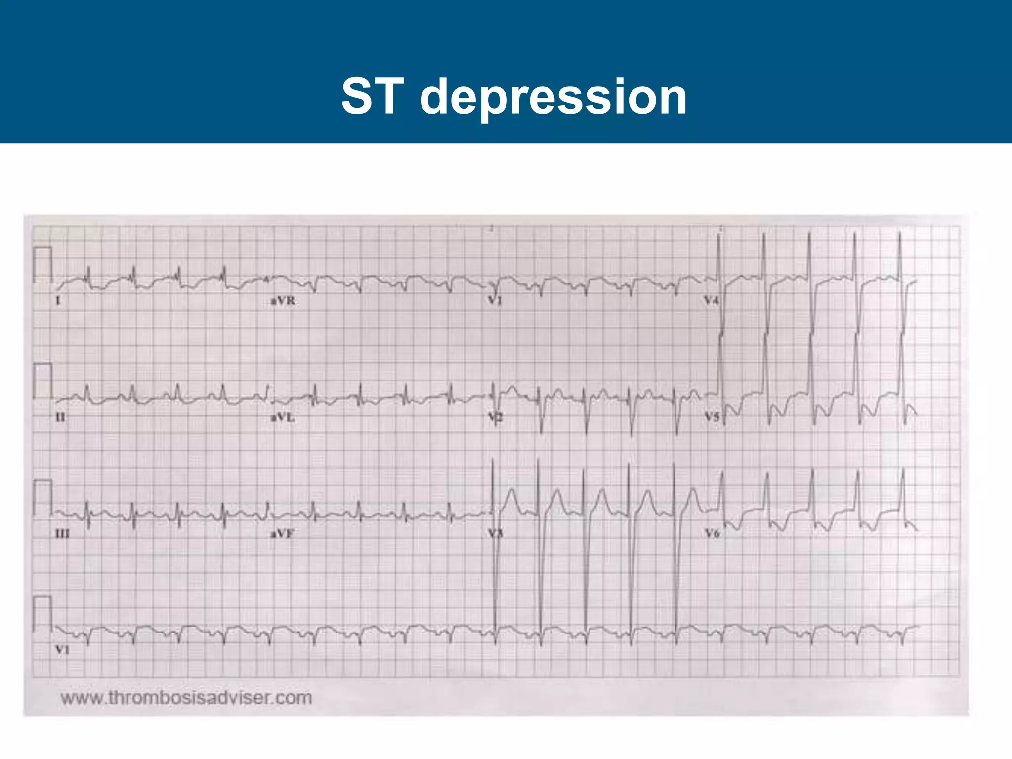 ECG interpretation: NSTEMI | PPTX