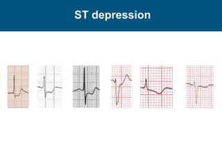 ECG interpretation: NSTEMI | PPTX
