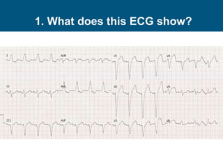 ECG interpretation: NSTEMI | PPTX