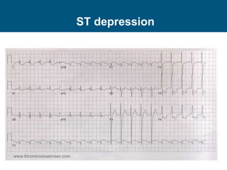 ECG interpretation: NSTEMI | PPTX