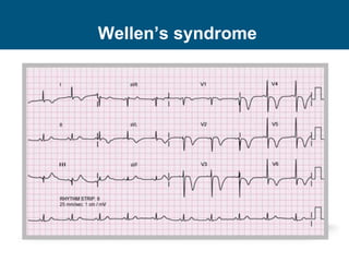 ECG interpretation: NSTEMI | PPTX