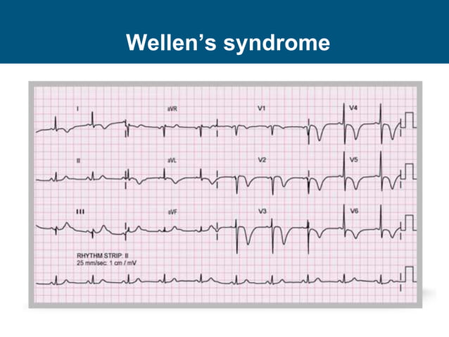 ECG interpretation: NSTEMI | PPT