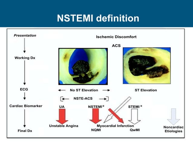 ECG interpretation: NSTEMI | PPT
