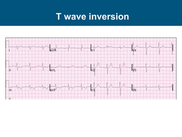 ECG interpretation: NSTEMI