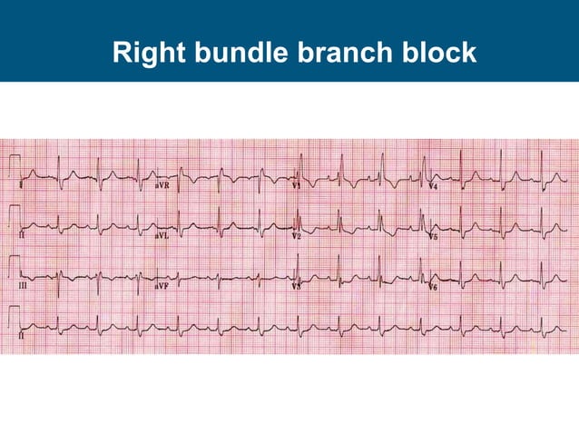 ECG interpretation: NSTEMI