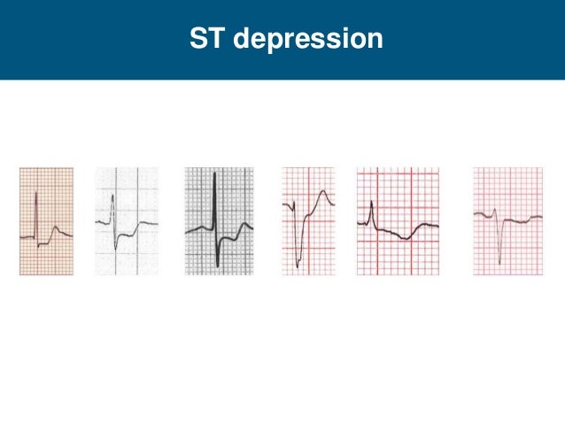 ECG interpretation: NSTEMI