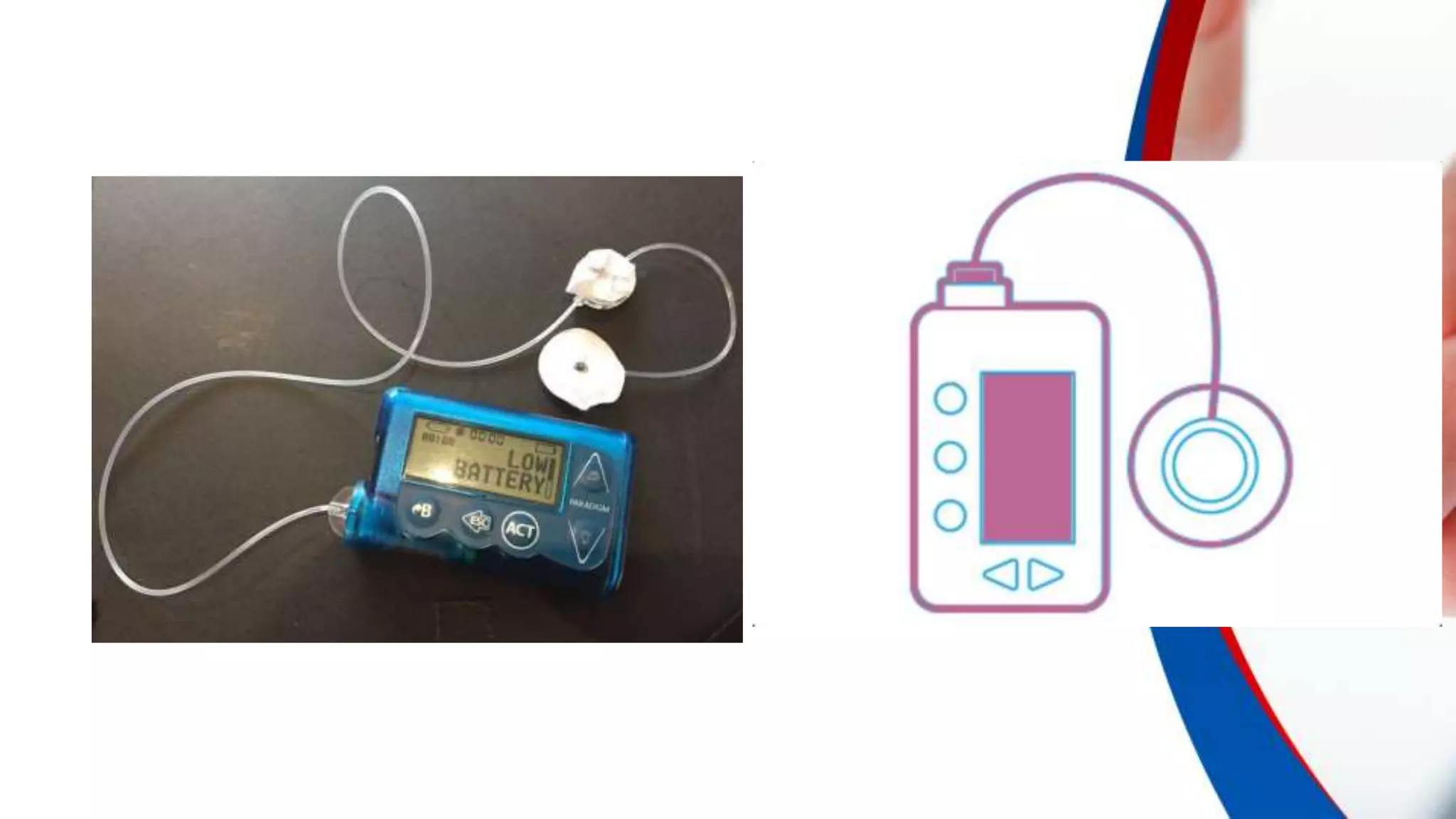 NEW TECHNOLOGY OF DIABETES.pptx