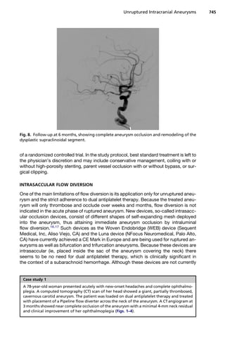 Therapies for Intracraneal Aneurysms | PDF