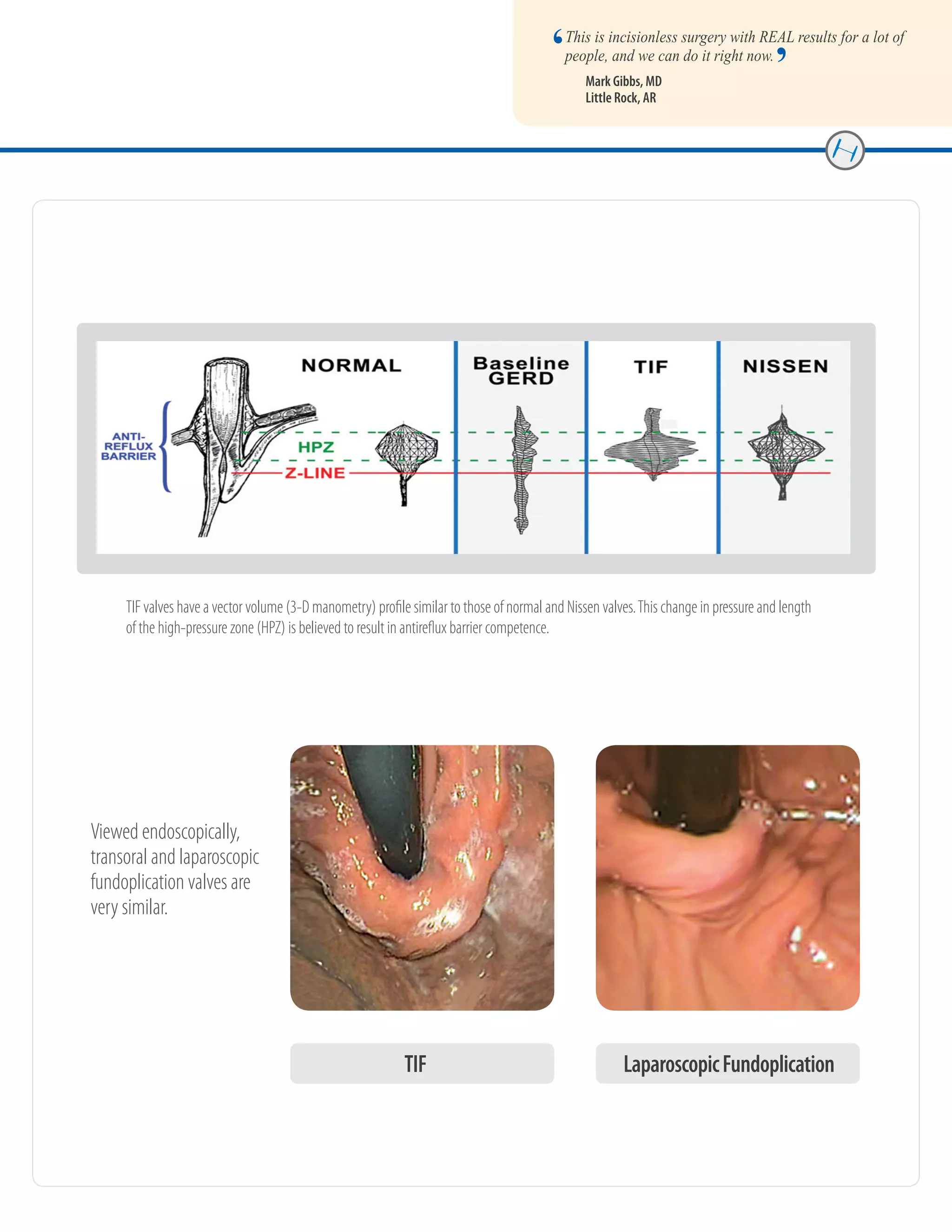 New Transoral Fundoplication Brochure | PDF