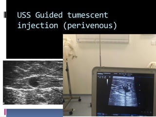 New treatment in varicose veins | PPTX