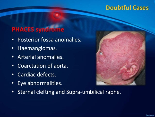 New trends in treatment of Infantile hemangioma