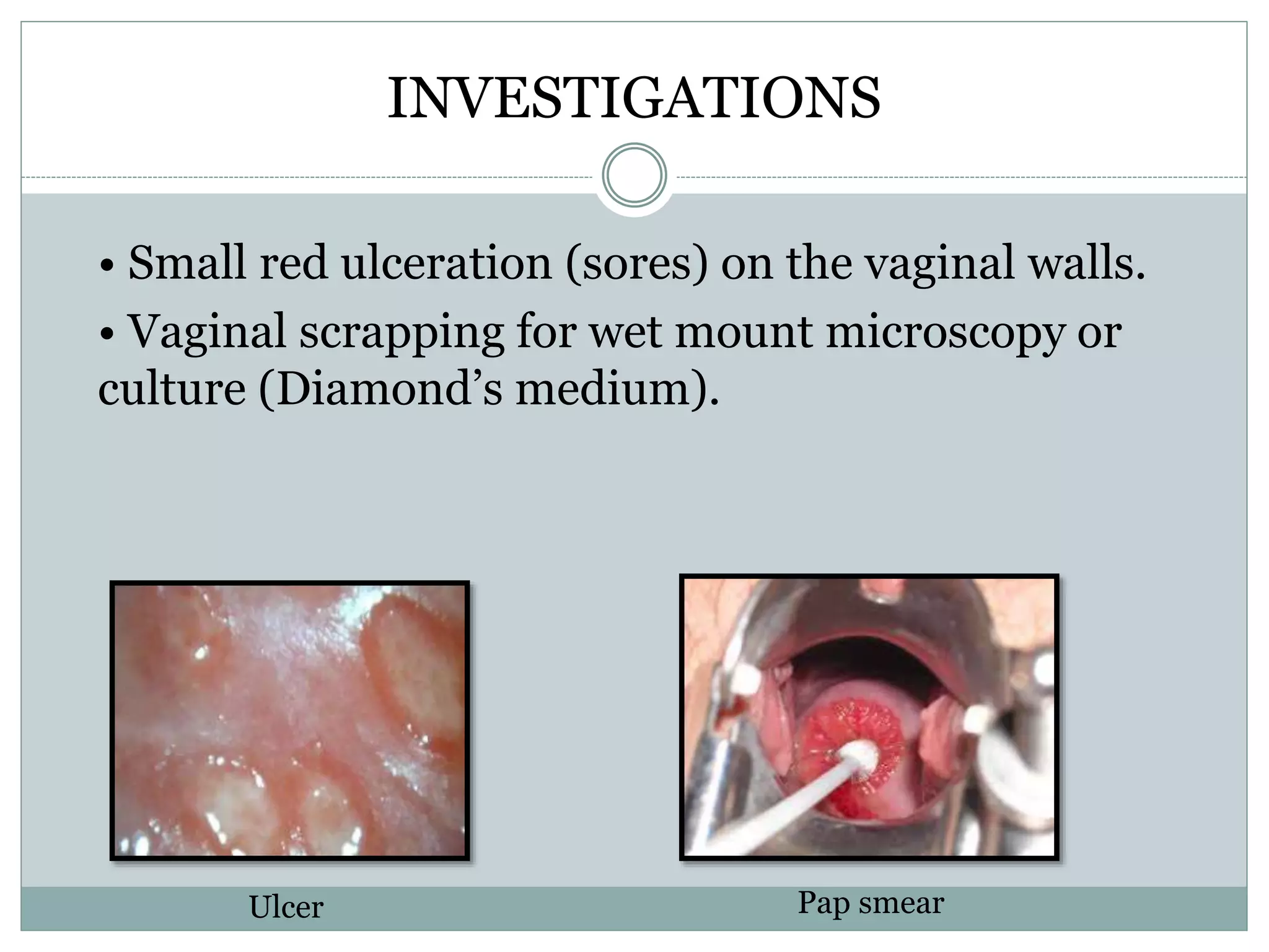 trichomoniasis | PPTX