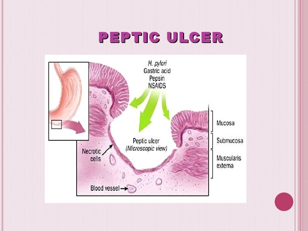 Peptic