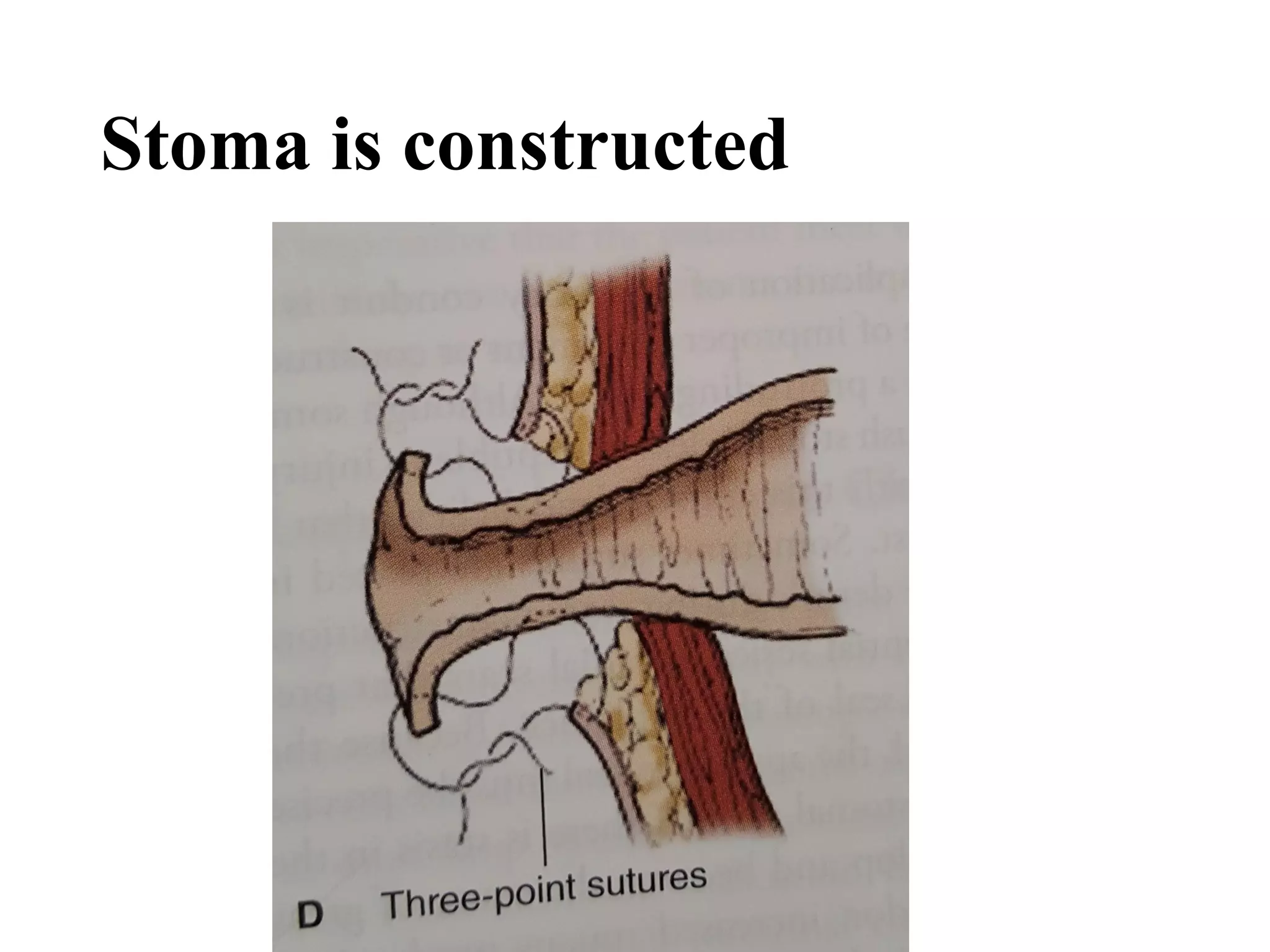 urinary diversions in bladder cancer | PPT