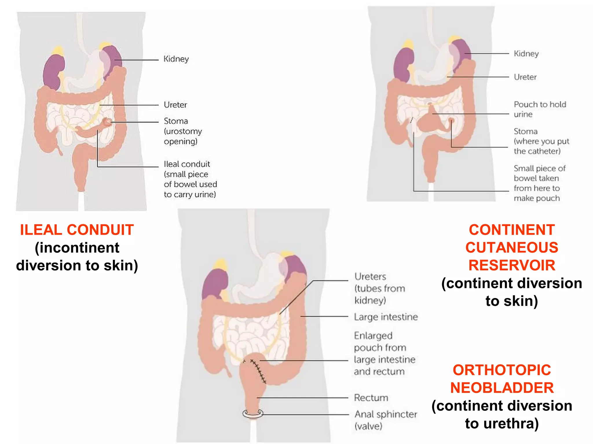 urinary diversions in bladder cancer | PPT