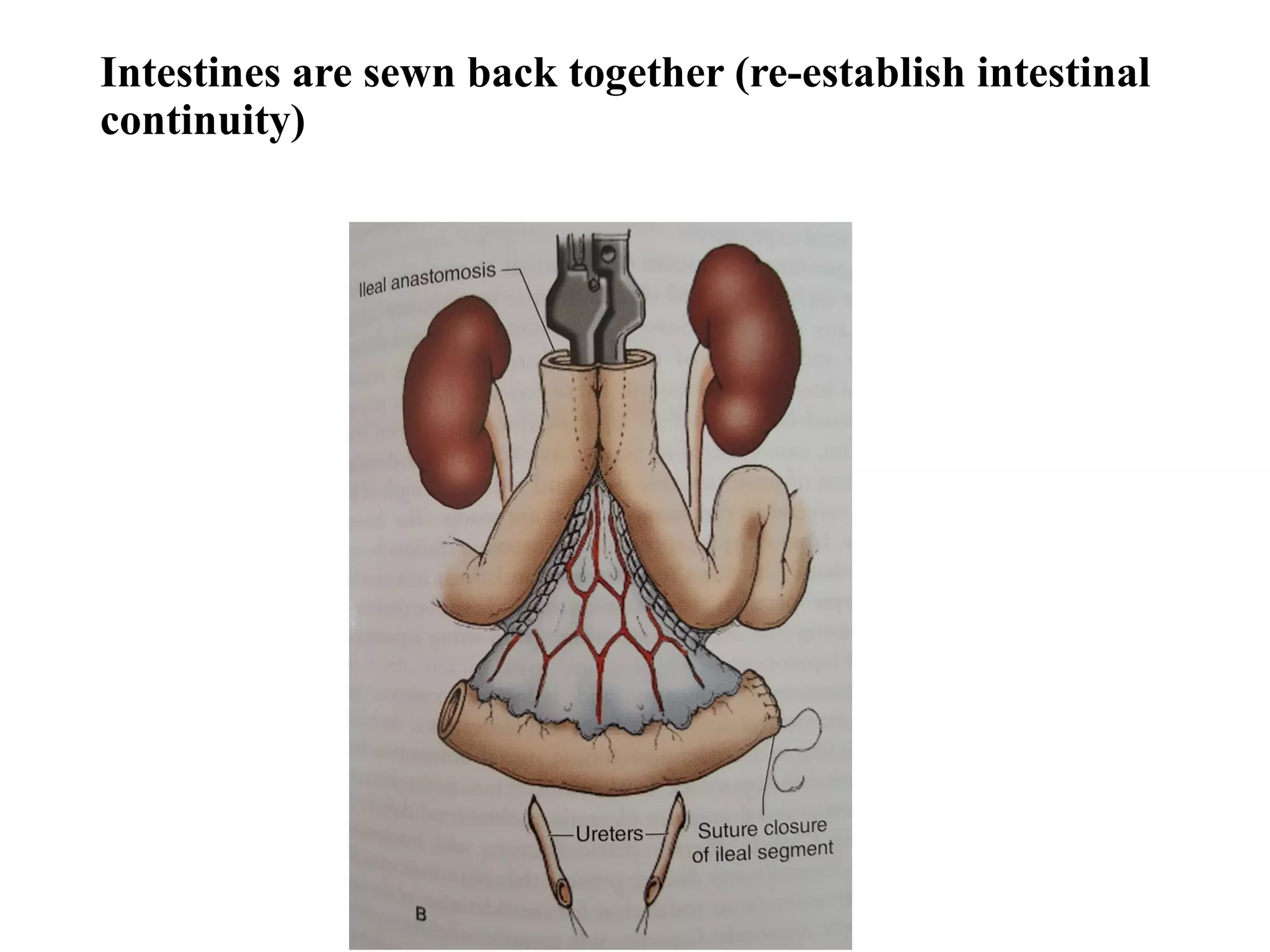 urinary diversions in bladder cancer | PPT