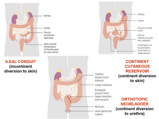 urinary diversions in bladder cancer | PPT