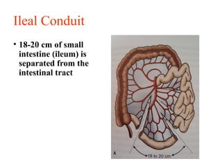urinary diversions in bladder cancer | PPT