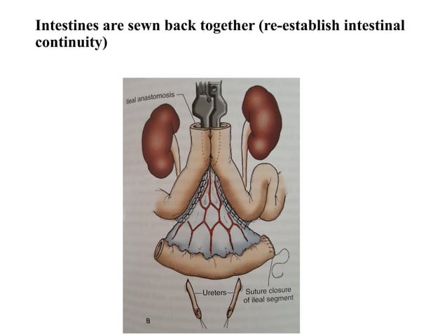 urinary diversions in bladder cancer | PPT