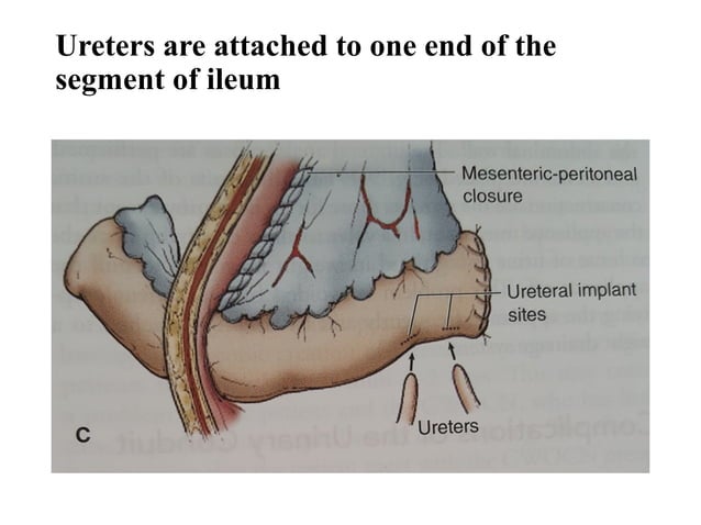 urinary diversions in bladder cancer | PPT