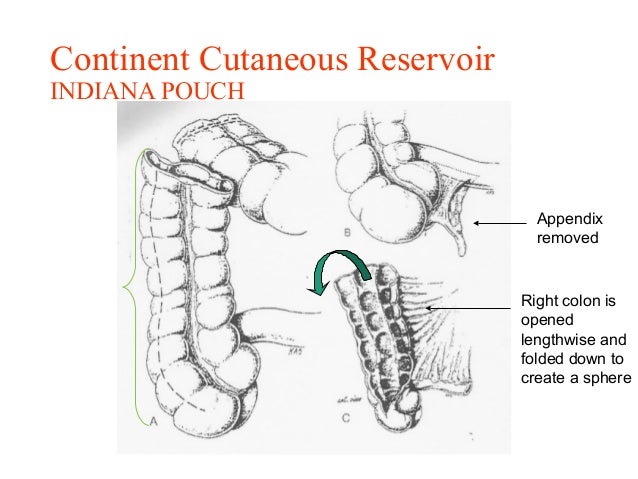 urinary diversions in bladder cancer