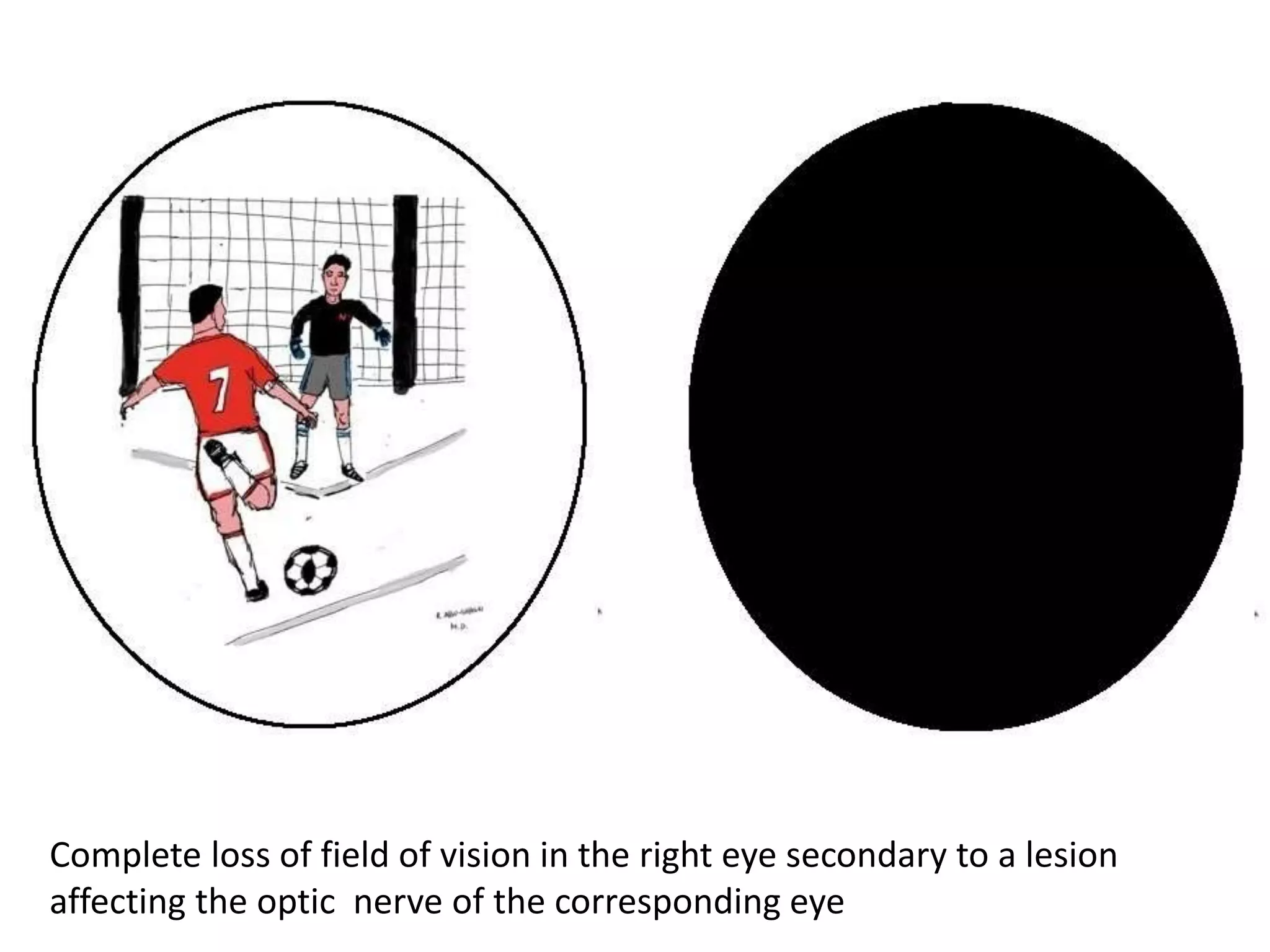 Visual Field Defects | PPTX