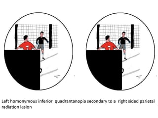 Visual Field Defects | PPTX
