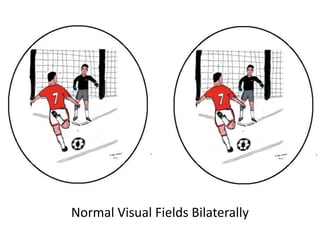 Visual Field Defects | PPTX