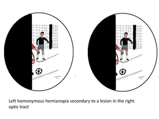 Visual Field Defects | PPTX