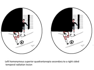 Visual Field Defects | PPT