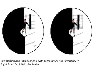 Visual Field Defects | PPT