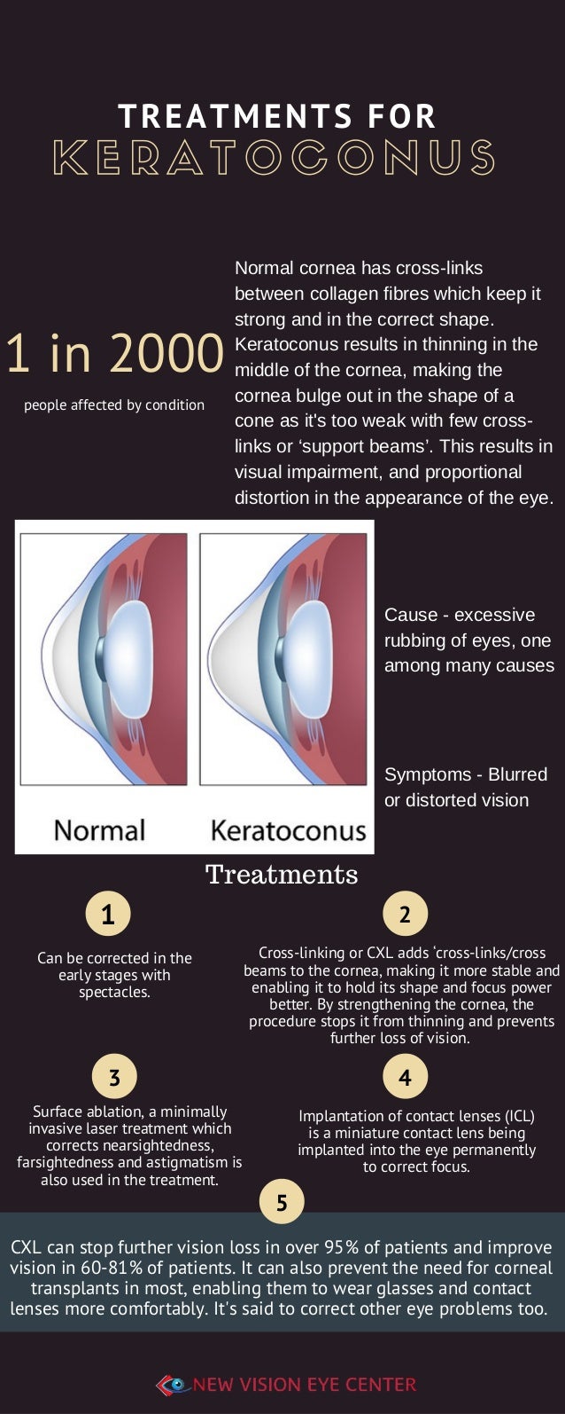 Treatments For Keratoconus