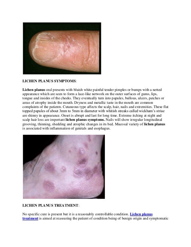 Lichen Planus Treatment, Diagnosis, Symptoms, Causes of Lichen Planus Lichen Planus Treatment, Diagnosis, Symptoms, Causes of Lichen Planus