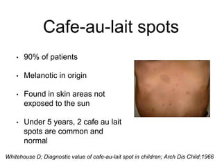 Neurofibromatosis and the spine | PPTX