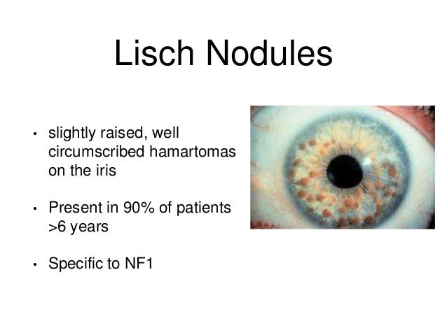 Neurofibromatosis and the spine