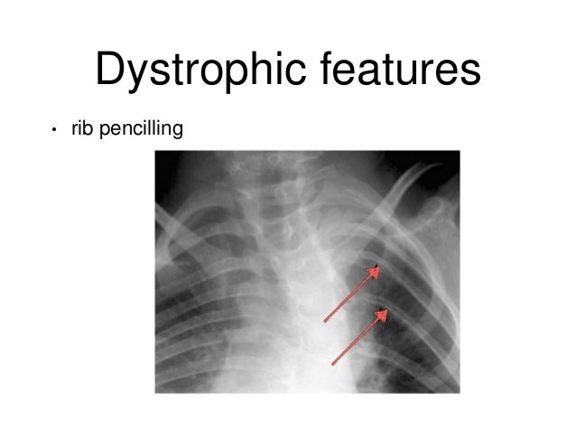 Neurofibromatosis and the spine