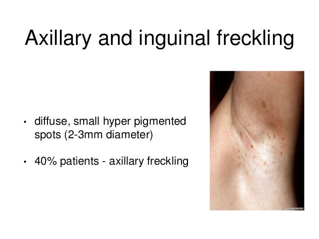 Neurofibromatosis and the spine