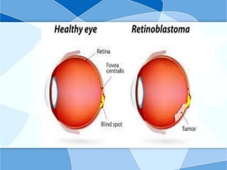 Retinoblastoma | PPT