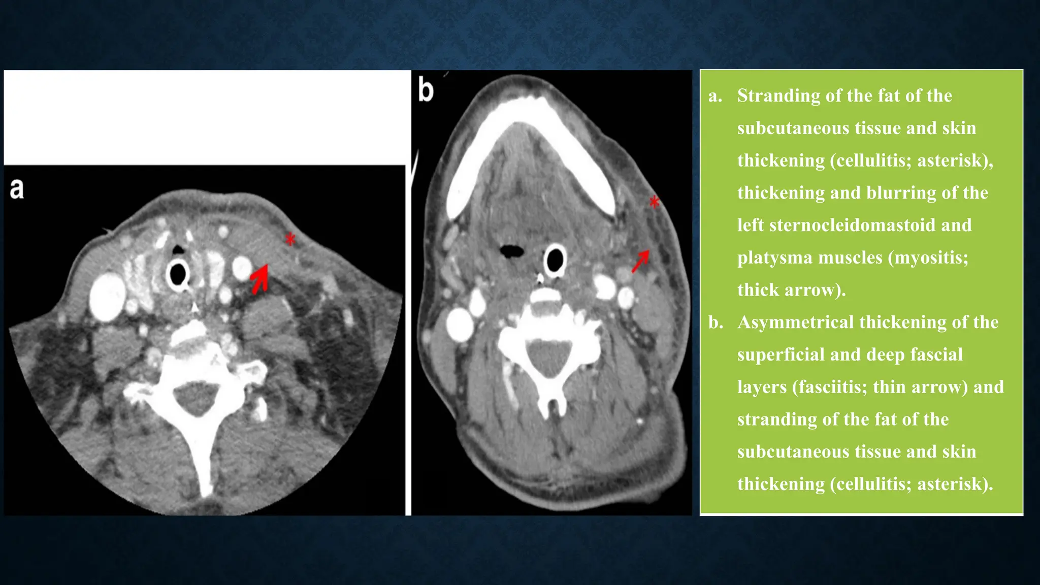 necrotizing soft tissue infection vs cellulitis | PPTX