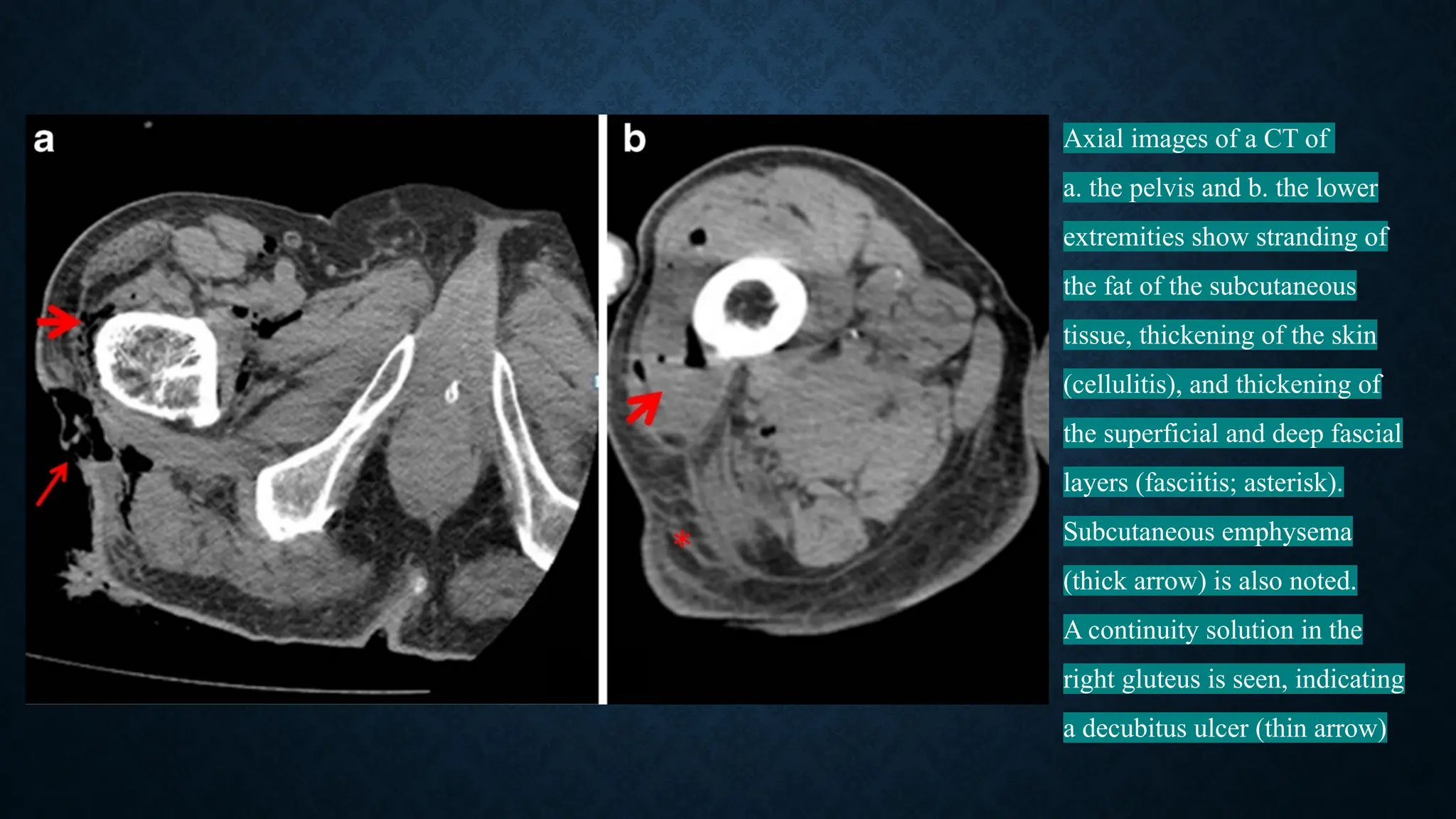 necrotizing soft tissue infection vs cellulitis | PPTX
