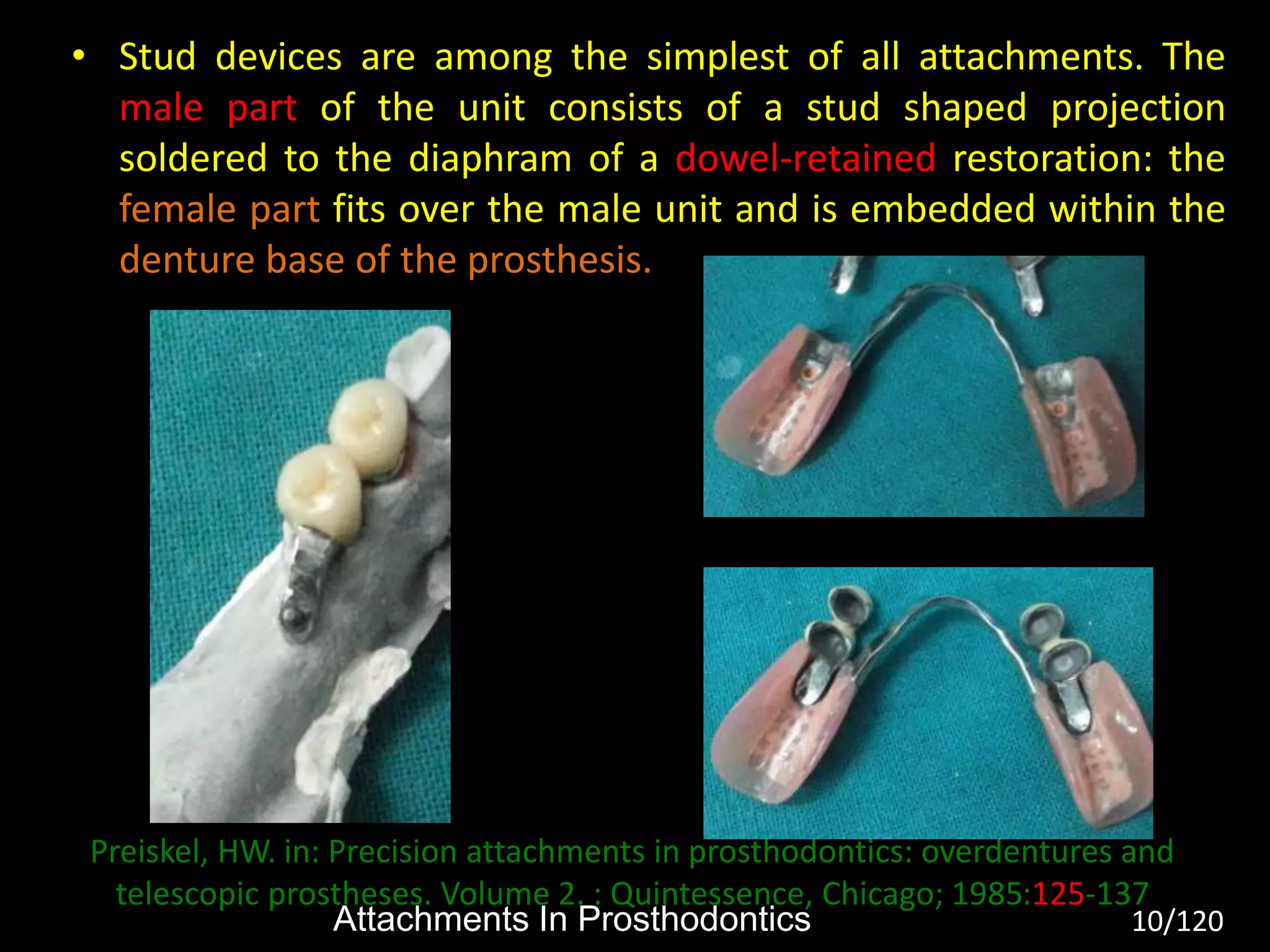 Attachments In Prosthodontics | PPTX